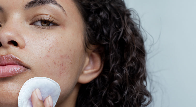 How do you get rid of acne scars? | Obagi Medical